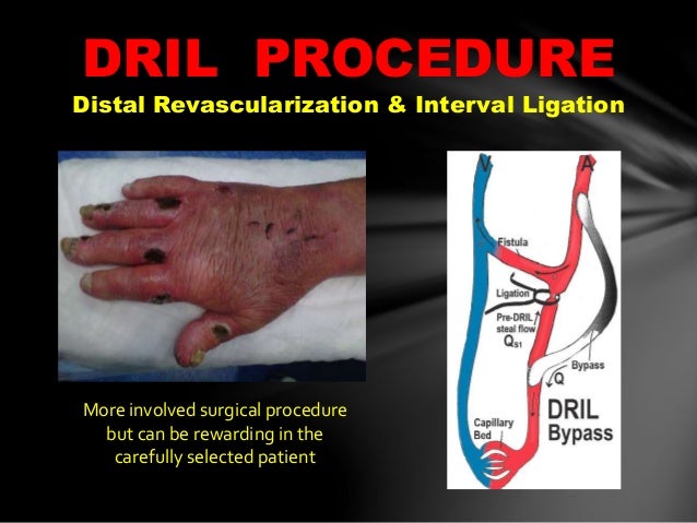 Complications and management of av access