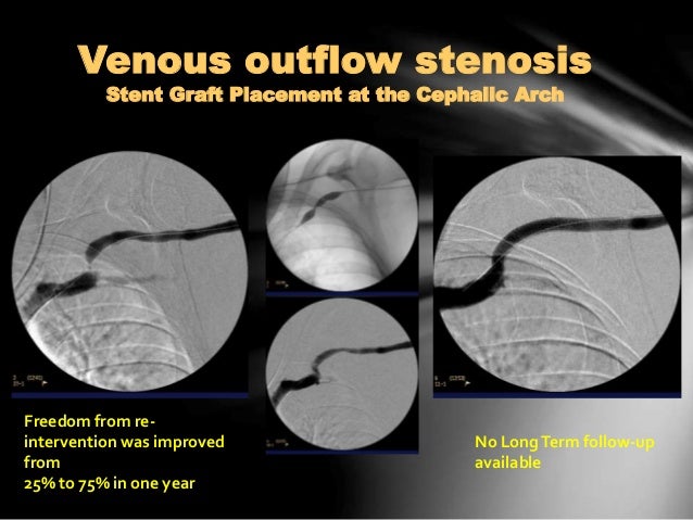 Complications and management of av access