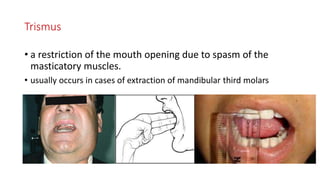 Complications following oral surgery.pptx