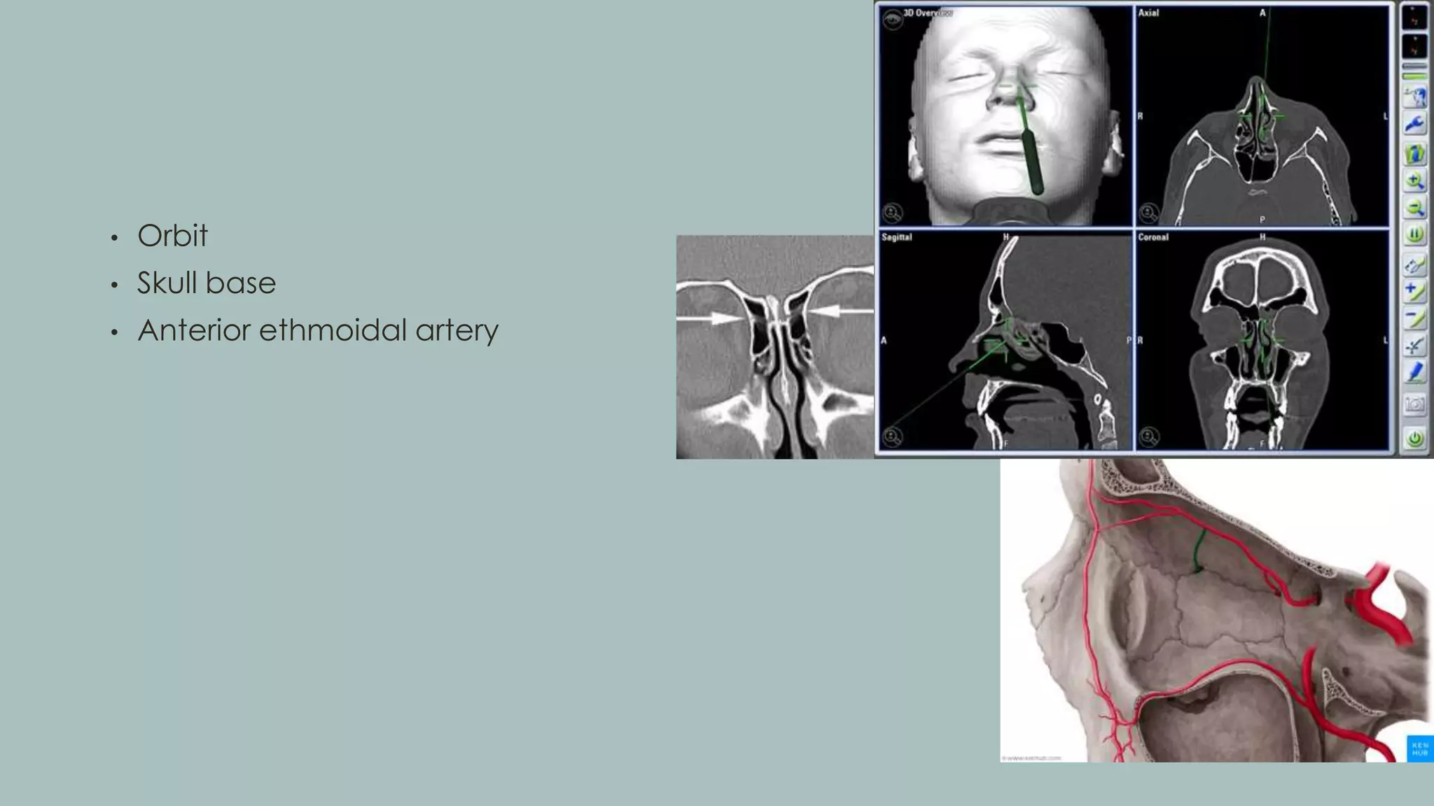 Endoscopic Sinus Surgery Complications – LLDD