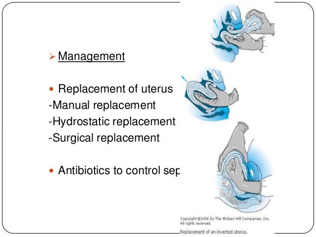 Inverted Uterus Pregnancy