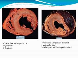 complicationsofacutemi.pptx