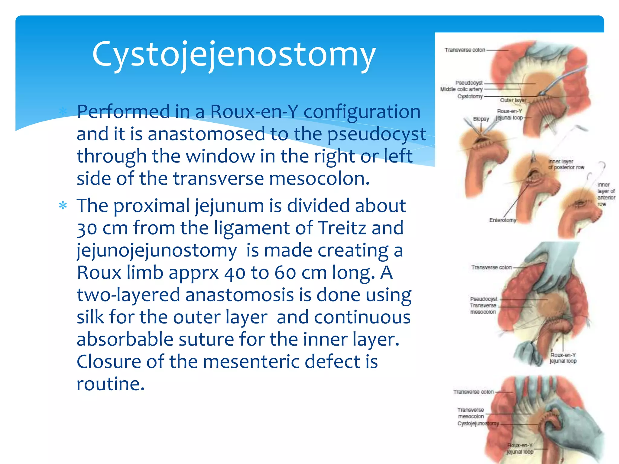 Complications of acute panctratitis | PPTX