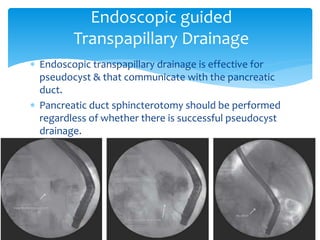 Complications of acute panctratitis | PPTX