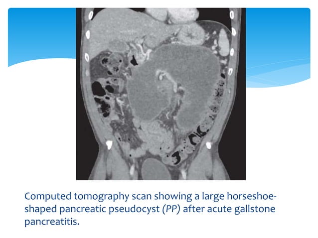 Complications of acute panctratitis | PPTX