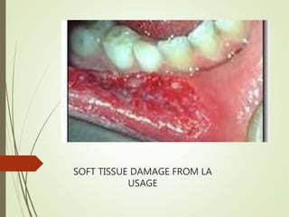 Complications of administering local anaesthesia and their management ...