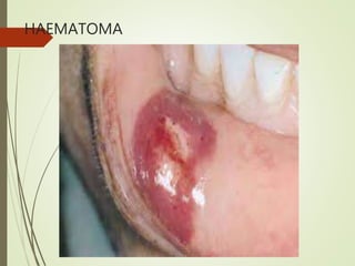 Complications of administering local anaesthesia and their management ...