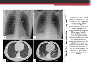Complications of Blood Trasfusion | PPTX
