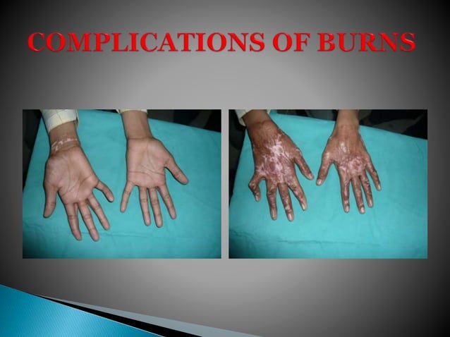 Complications of Burns | PPT