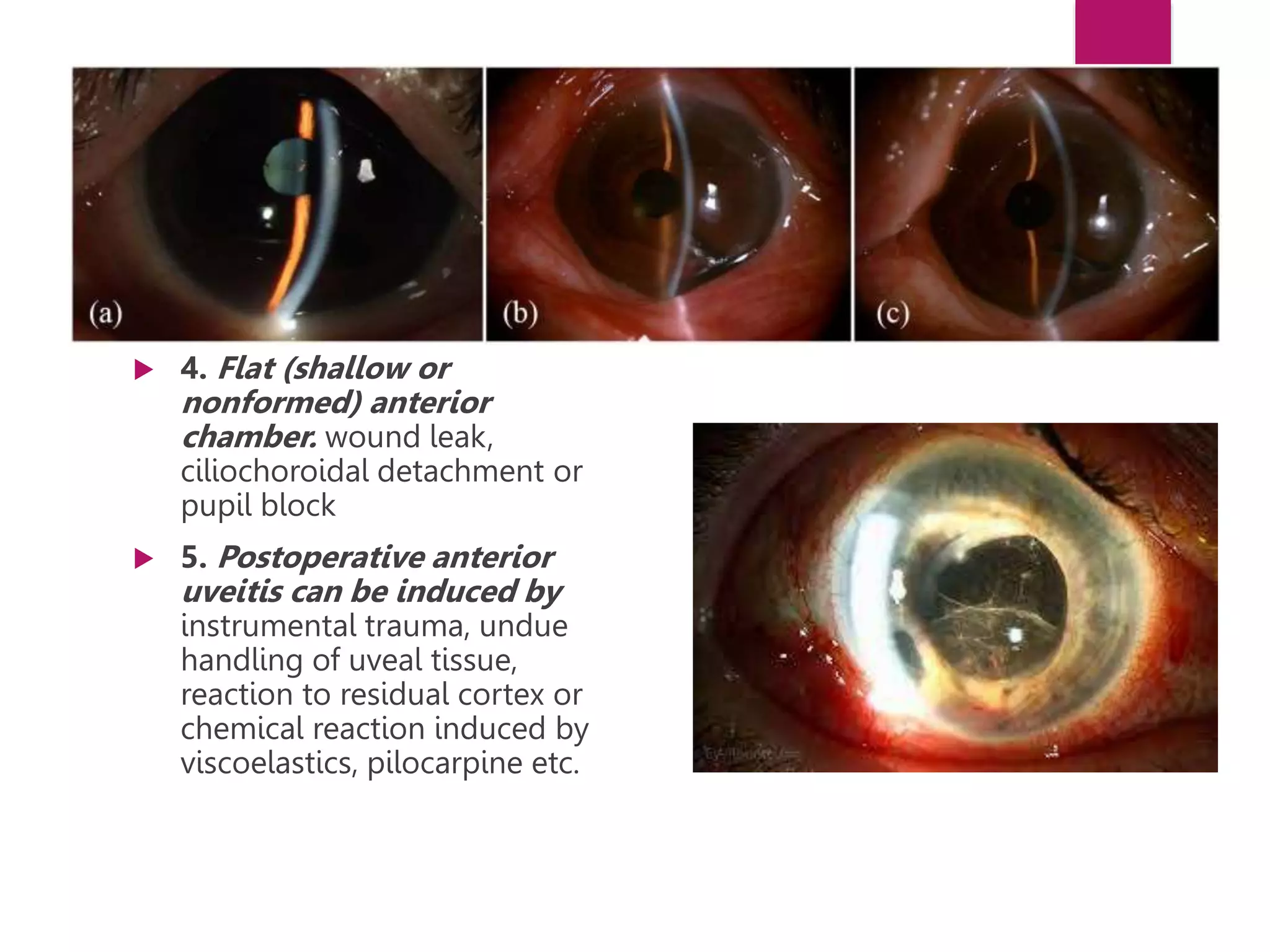 COMPLICATIONS OF CATARACT.pptx