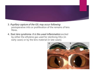 COMPLICATIONS OF CATARACT.pptx