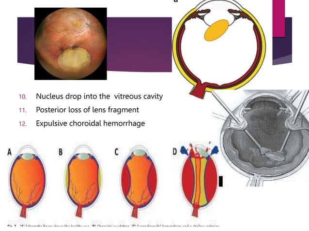 COMPLICATIONS OF CATARACT.pptx