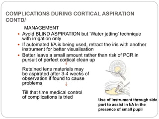 Complications of cataract surgery | PPTX