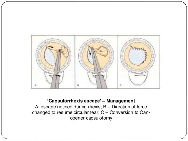 Complications of cataract surgery