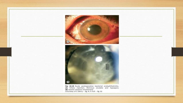 Complications of cataract surgery.pptx