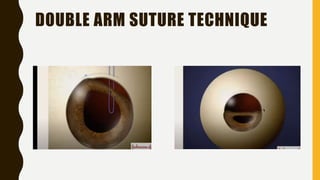 Complications of cataract surgery by Dr. Iddi.pptx