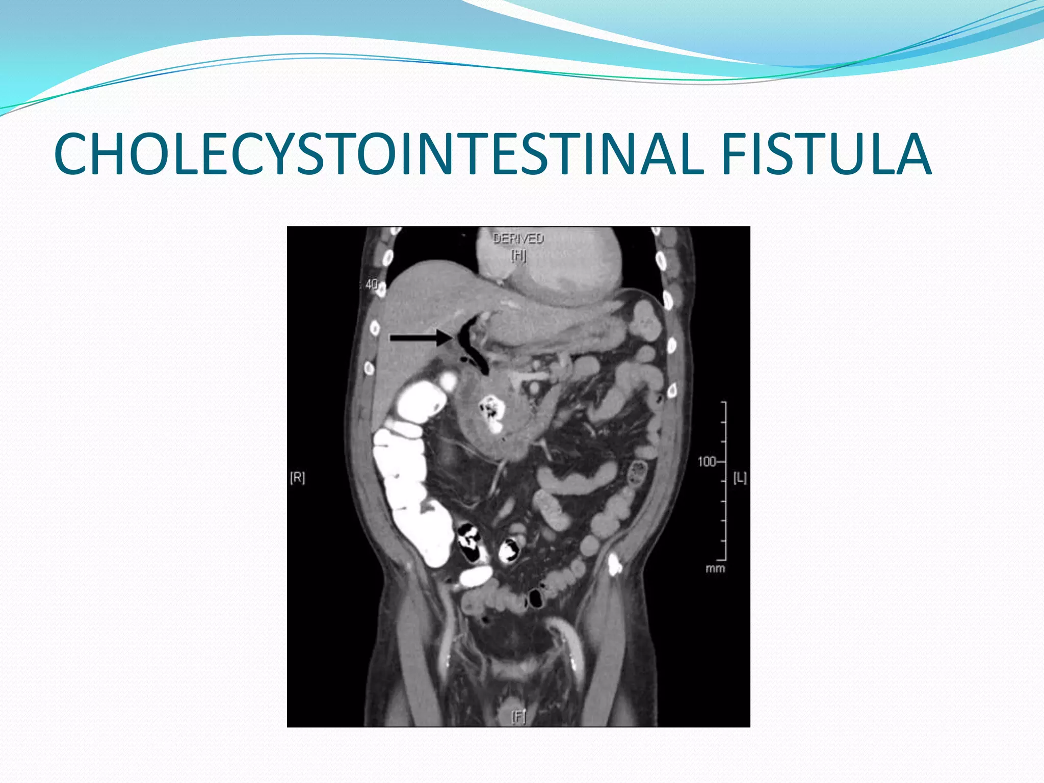 Complications of cholecystitis | PPTX