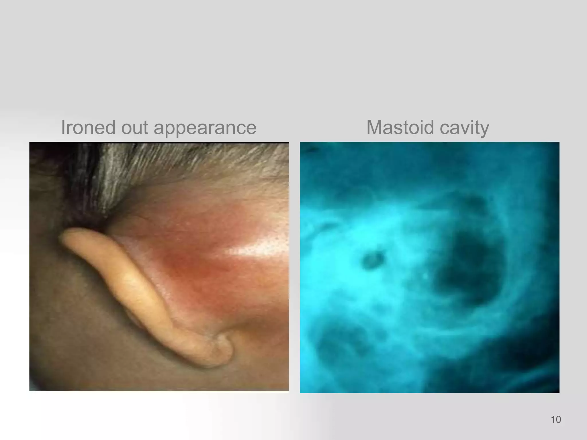 Complications of Chronic Otitis Media | PPTX