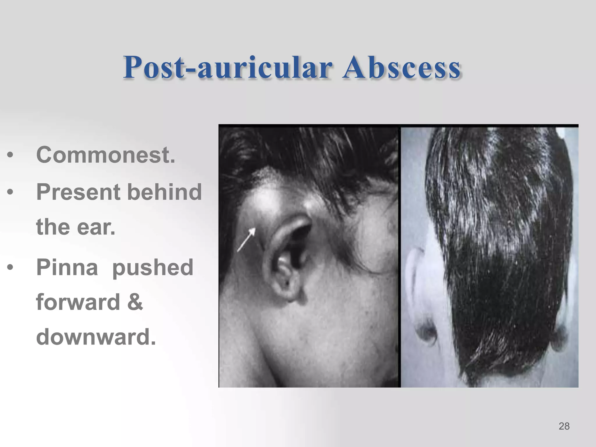 Complications of Chronic Otitis Media | PPTX