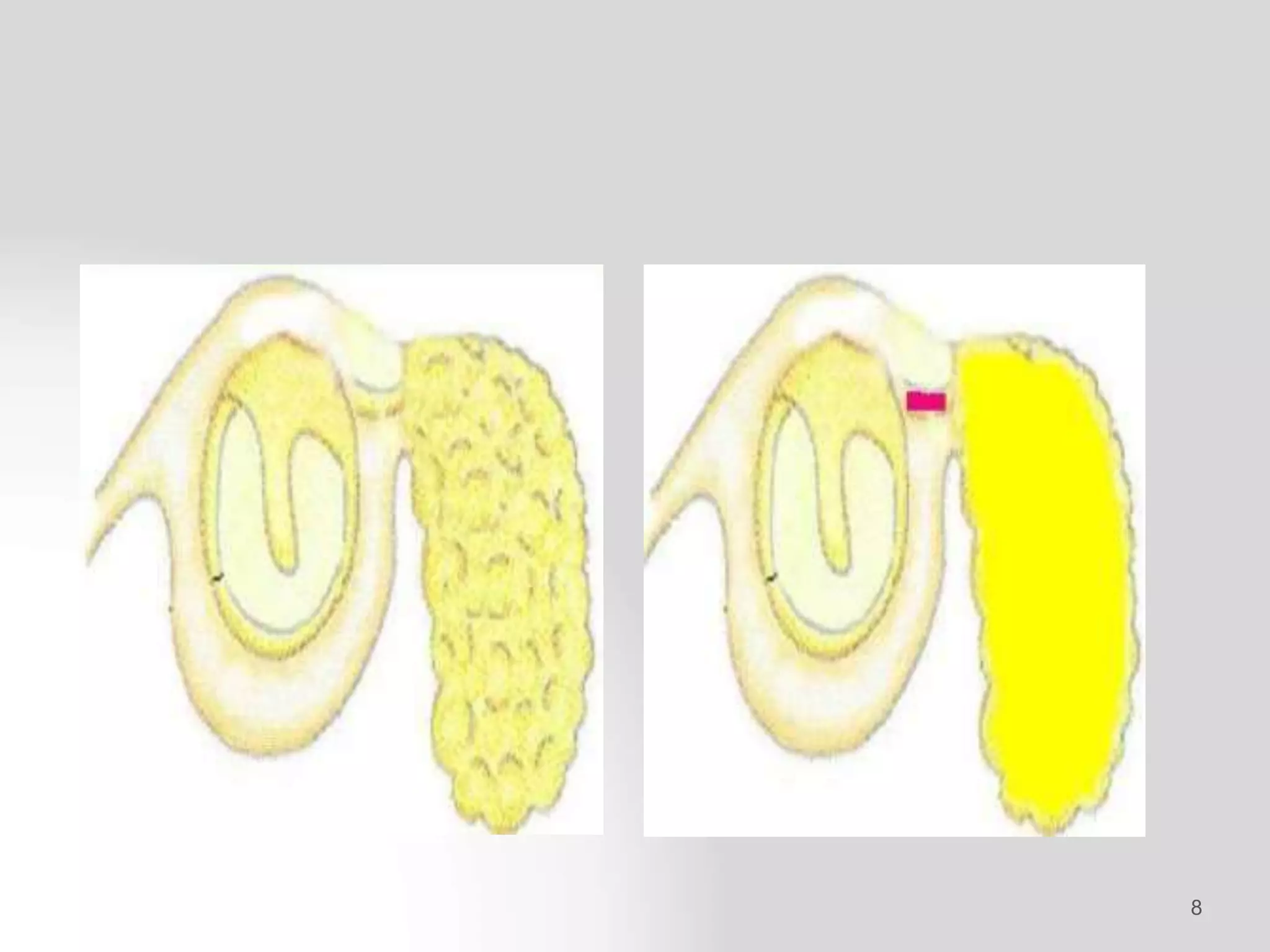 Complications of Chronic Otitis Media | PPTX