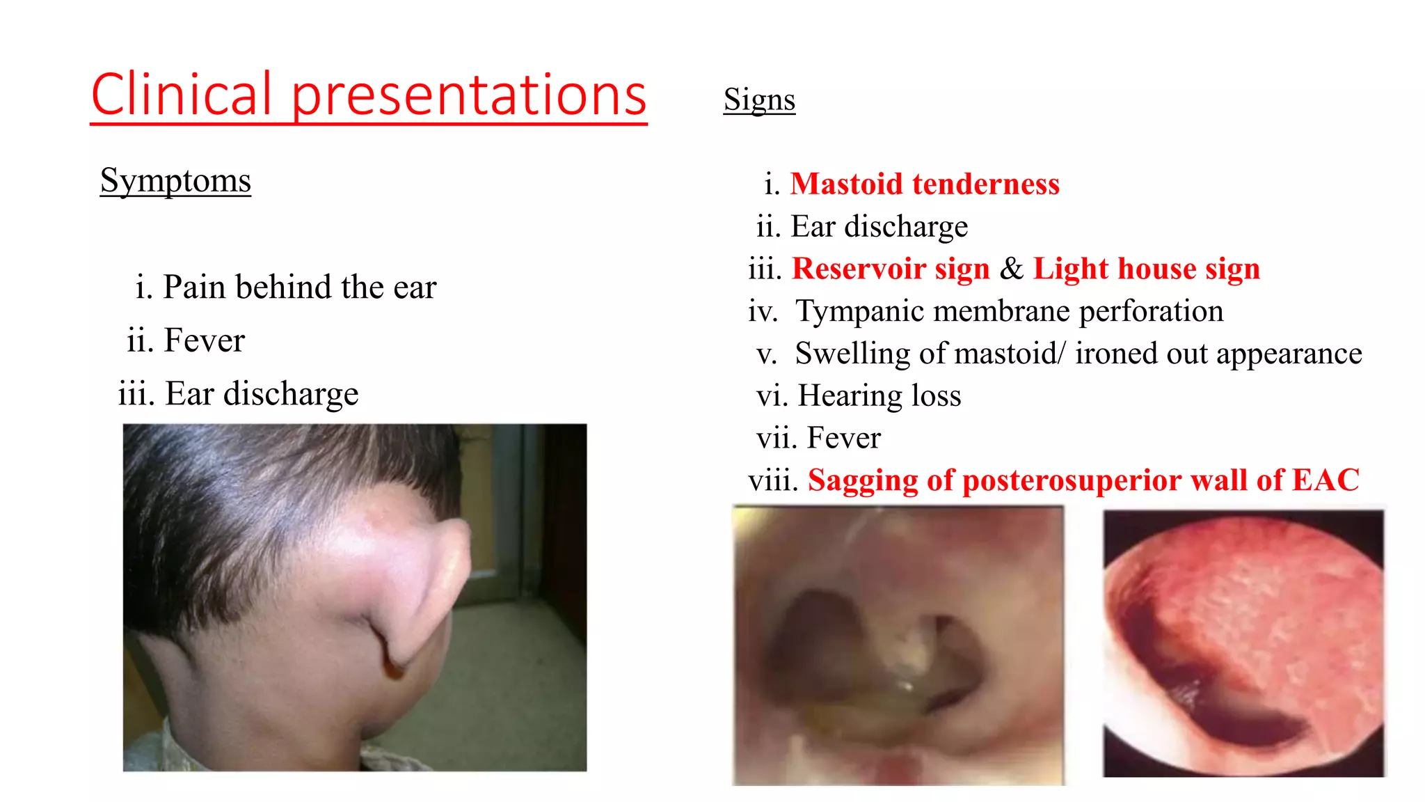 Complications of Chronic Otitis Media.pptx