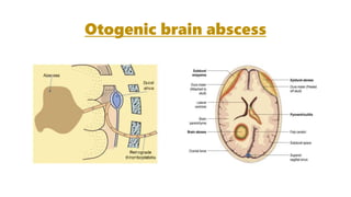 Complications of Chronic Otitis Media.pptx