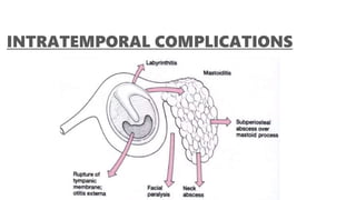 Complications of Chronic Otitis Media.pptx