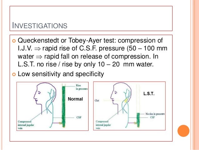 Complications of csom