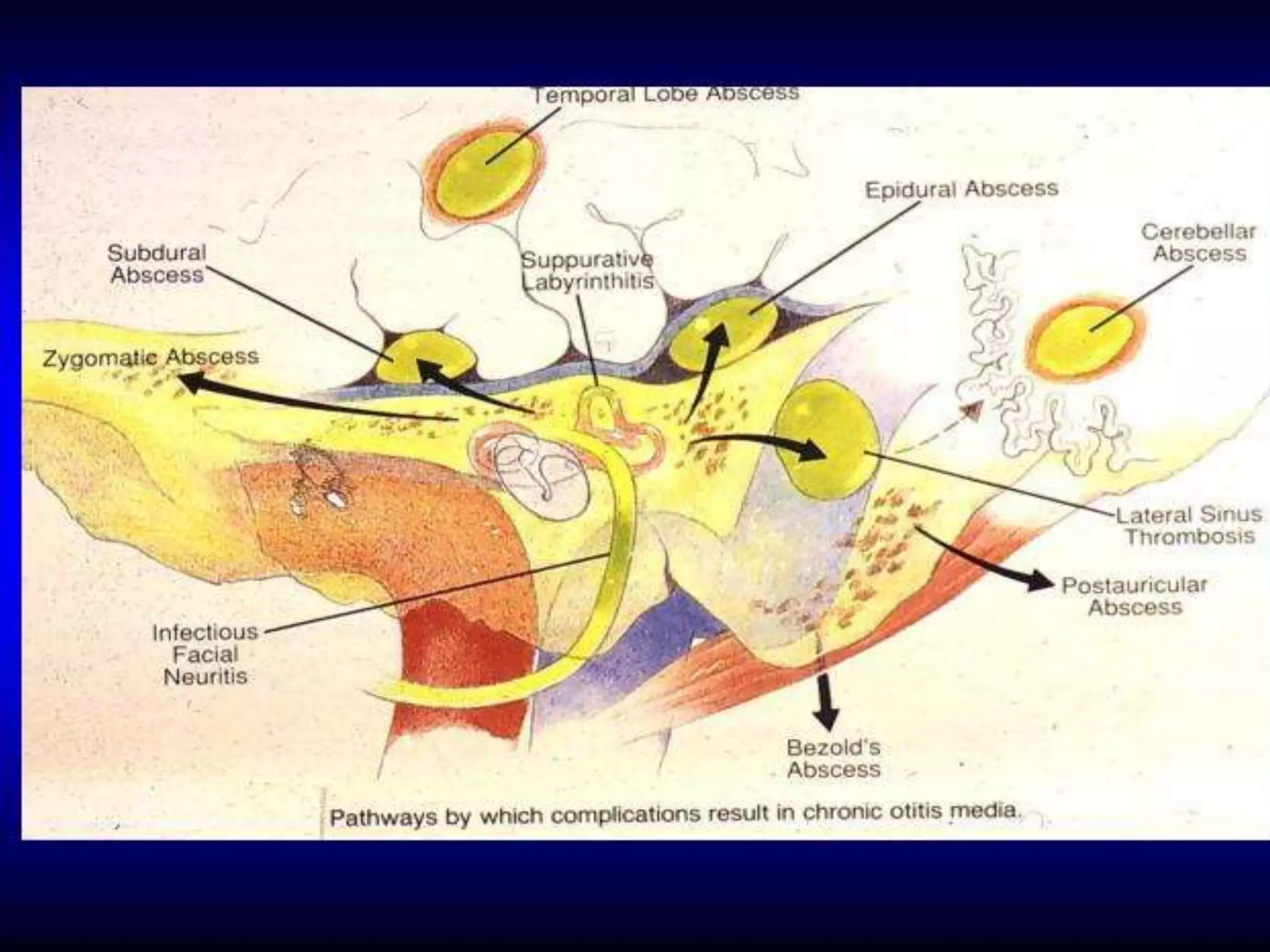 Complications of csom | PPTX