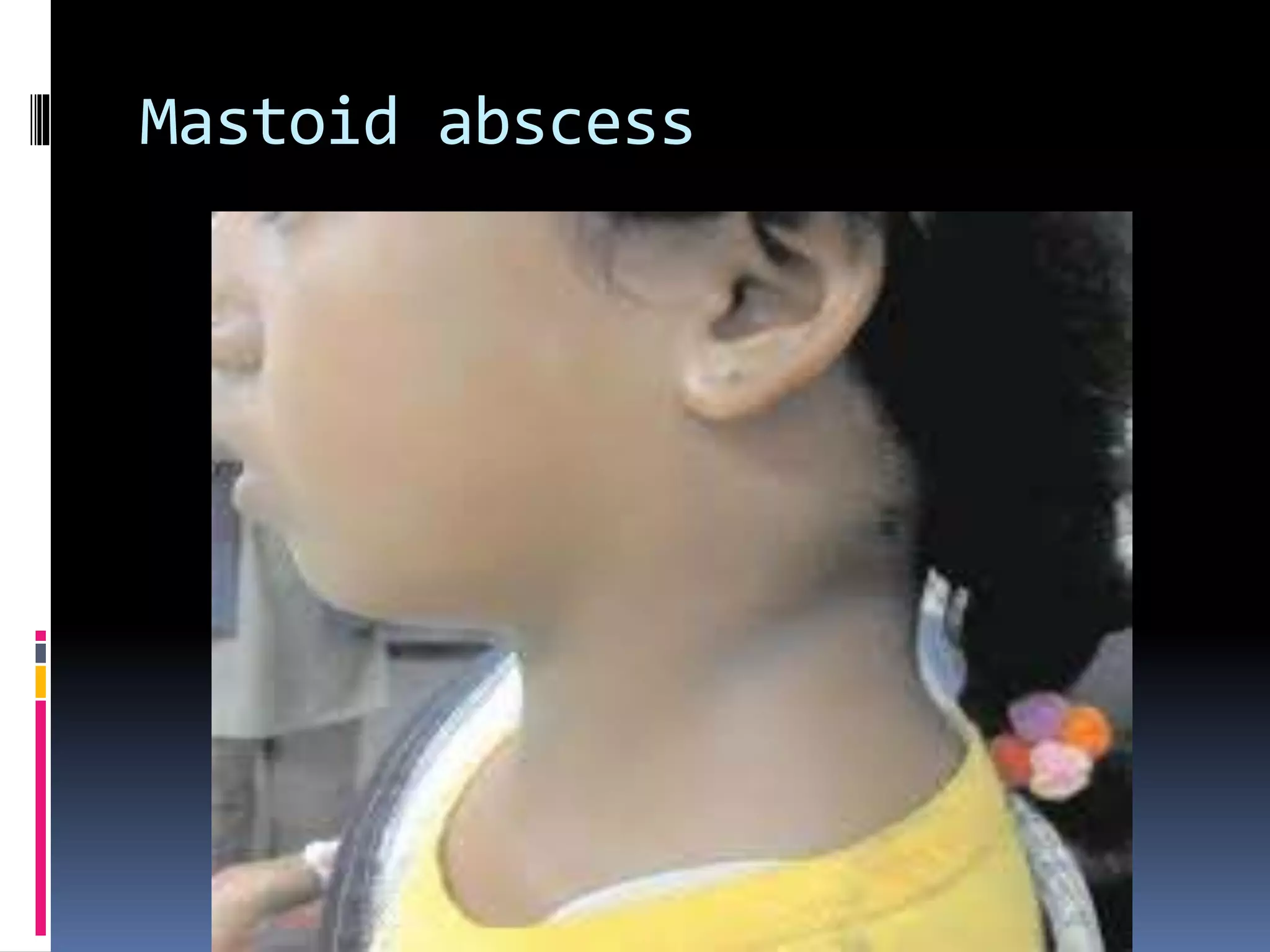 Complications of csom | PPTX