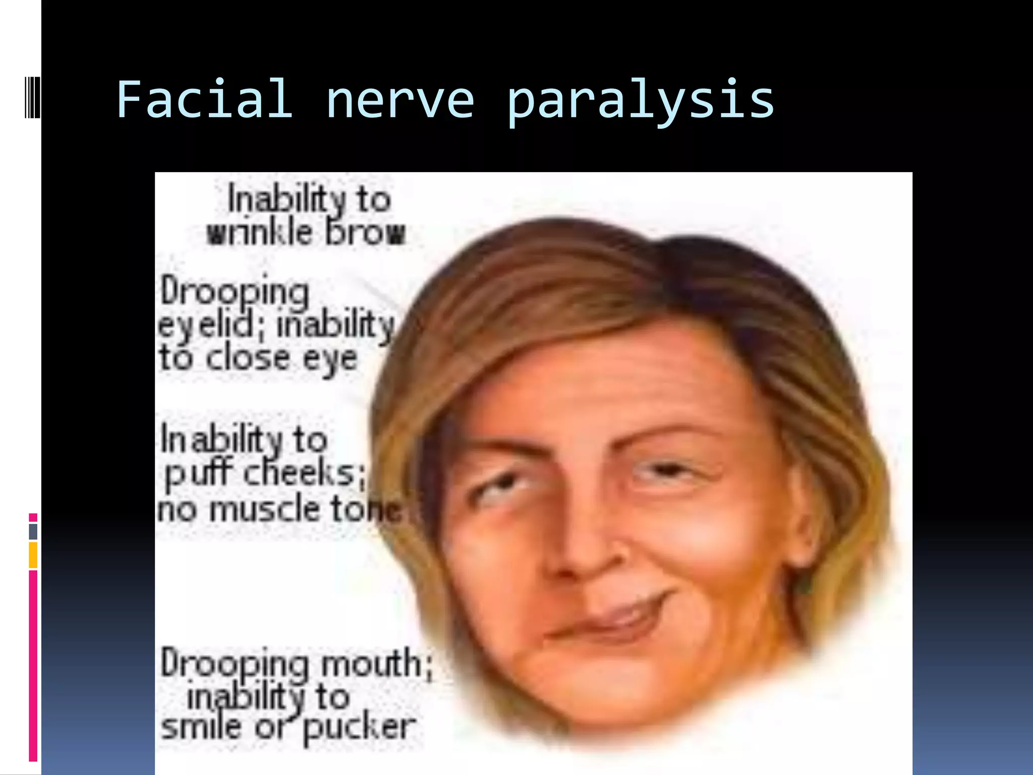 Complications of csom | PPTX
