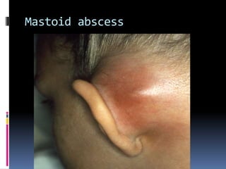 Complications of csom | PPTX