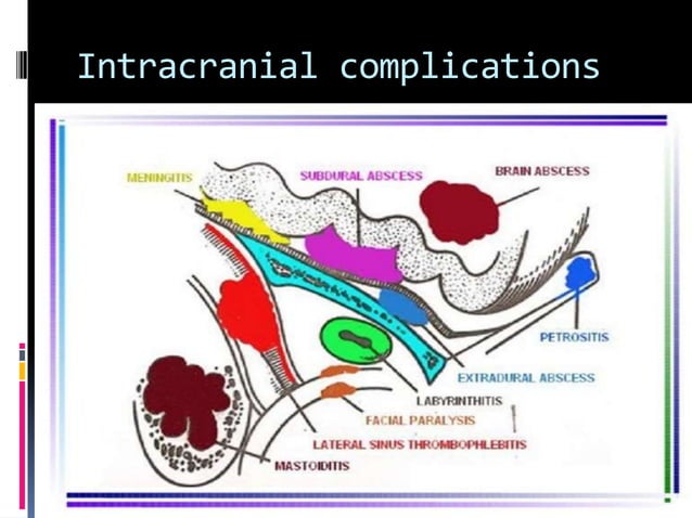Complications of csom | PPTX