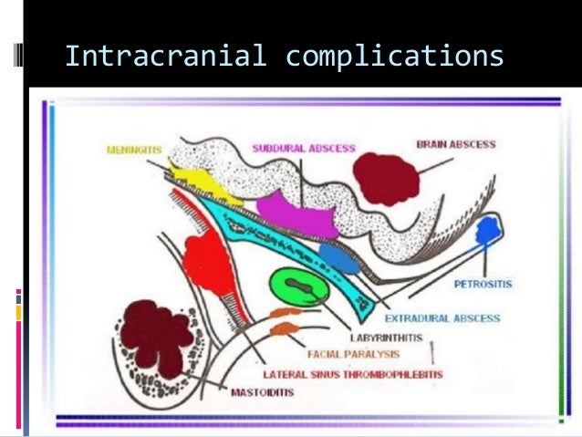 Complications of csom