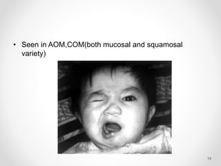 Complications of csom | PPT