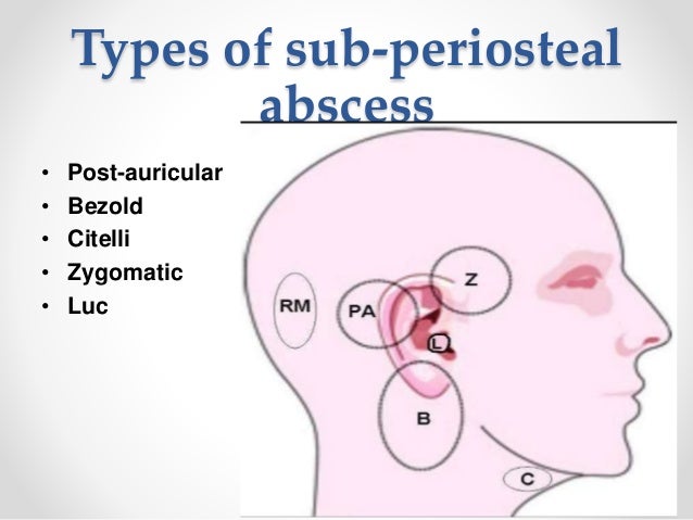 Complications of csom