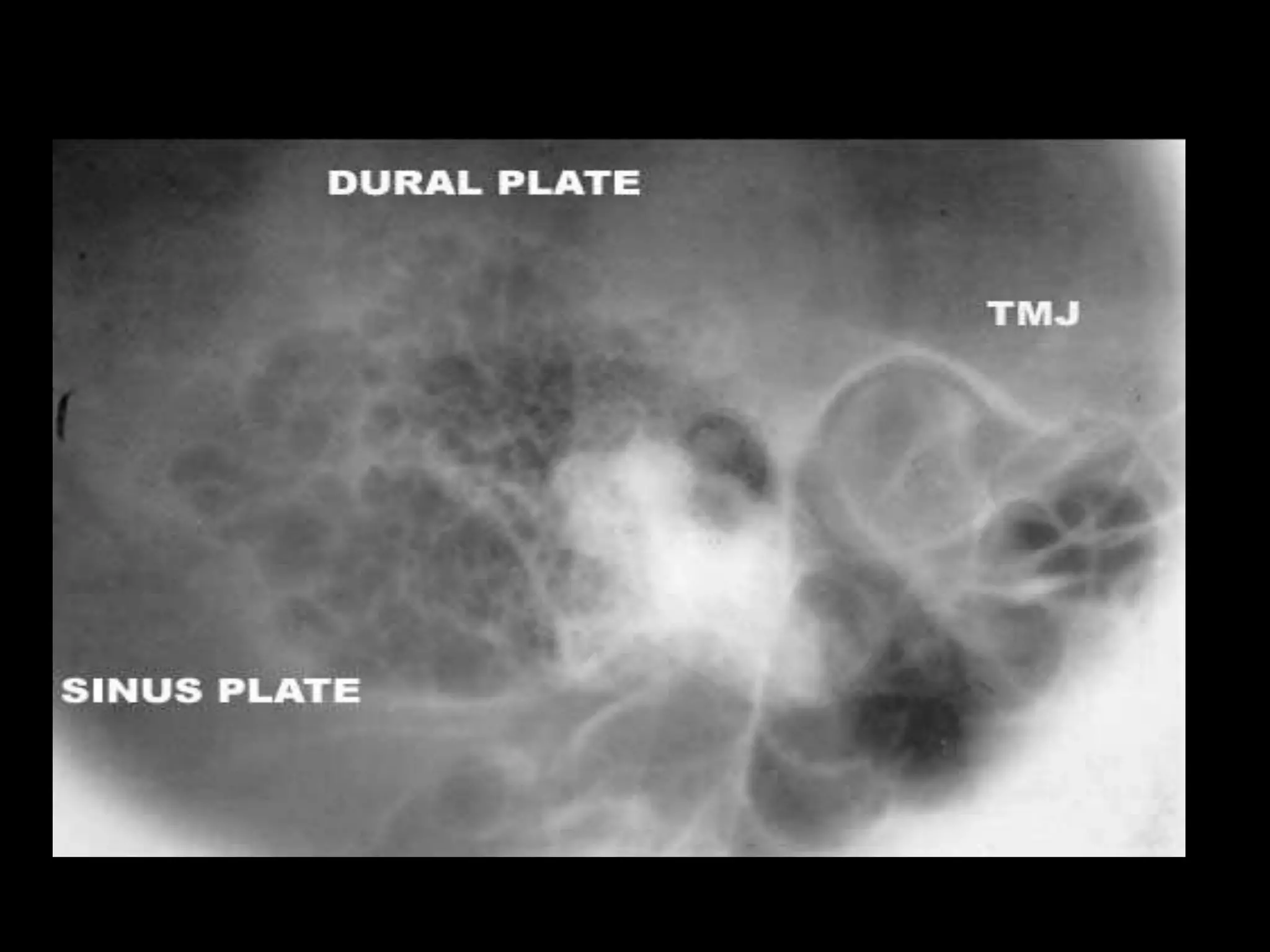Complications of csom | PPT | Ear, Nose and Throat Conditions ...