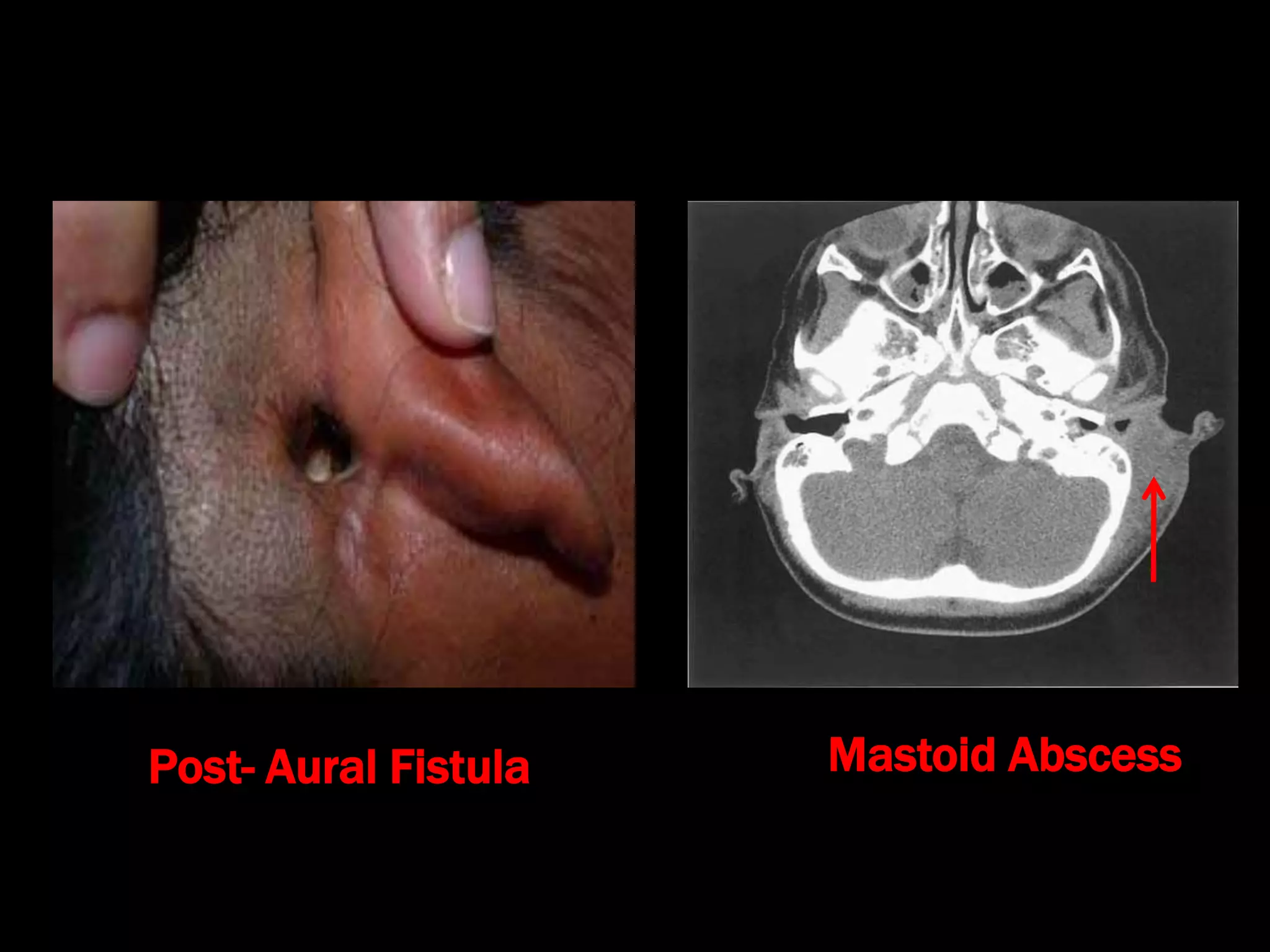 Complications of csom | PPT | Ear, Nose and Throat Conditions ...