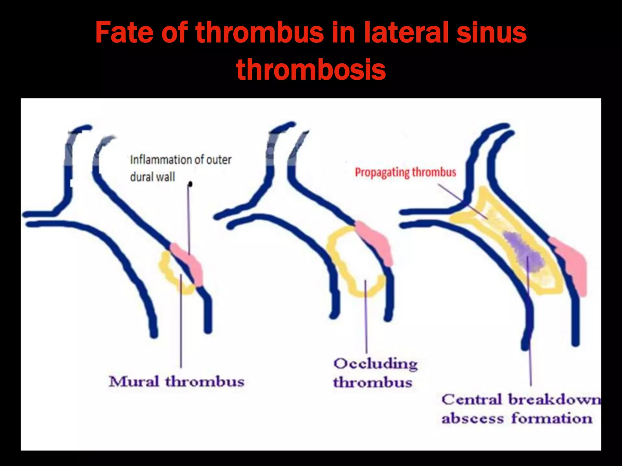Complications of csom | PPT | Ear, Nose and Throat Conditions ...
