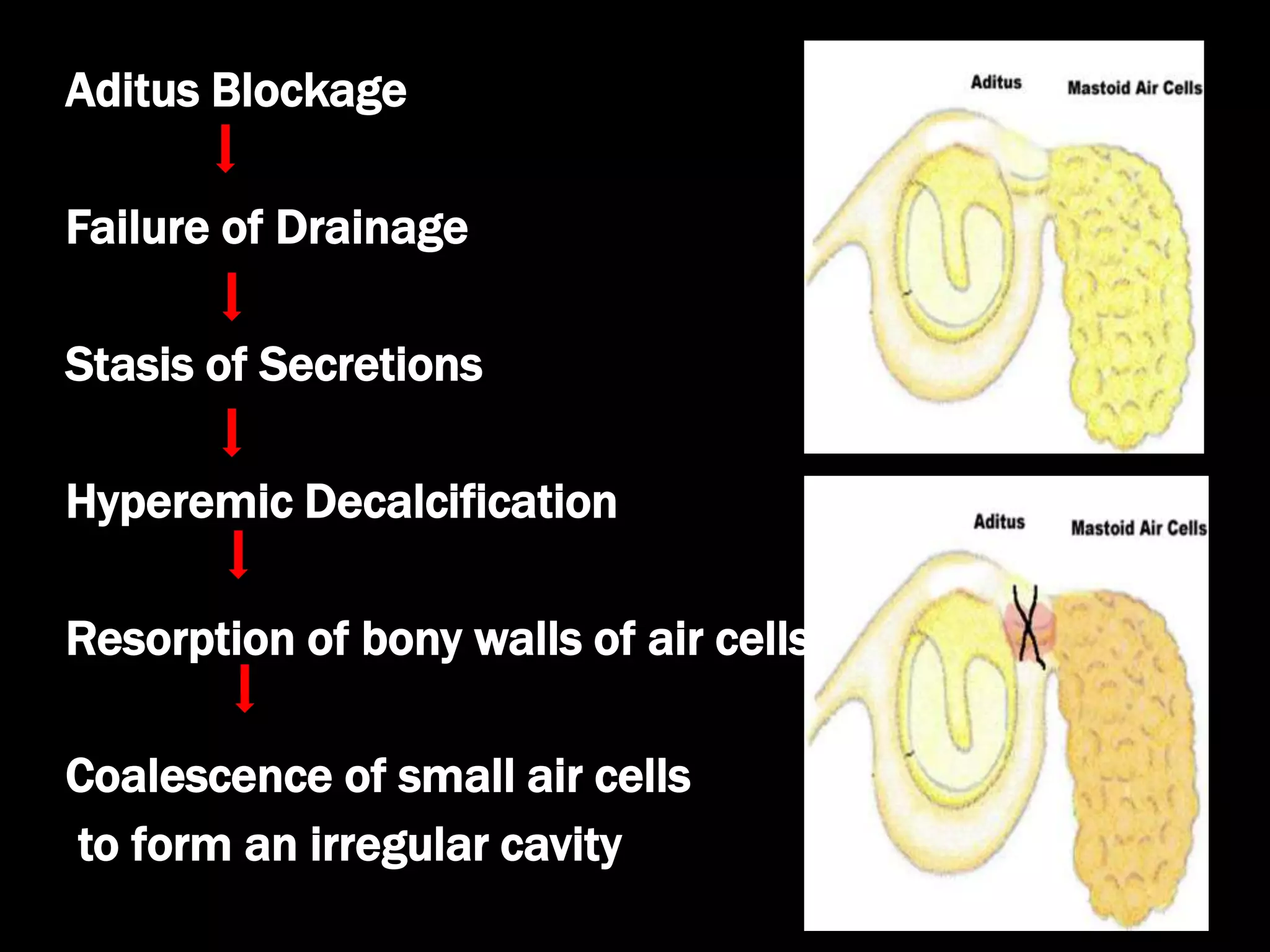 Complications of csom | PPT | Ear, Nose and Throat Conditions ...