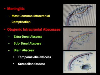 Complications of csom | PPT
