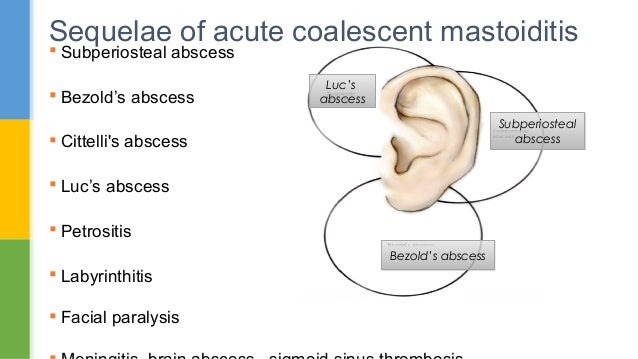 Complications of csom Dr.sithanandha Kumar,29.02.2016