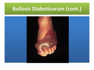 Bullosis Diabeticorum Hands