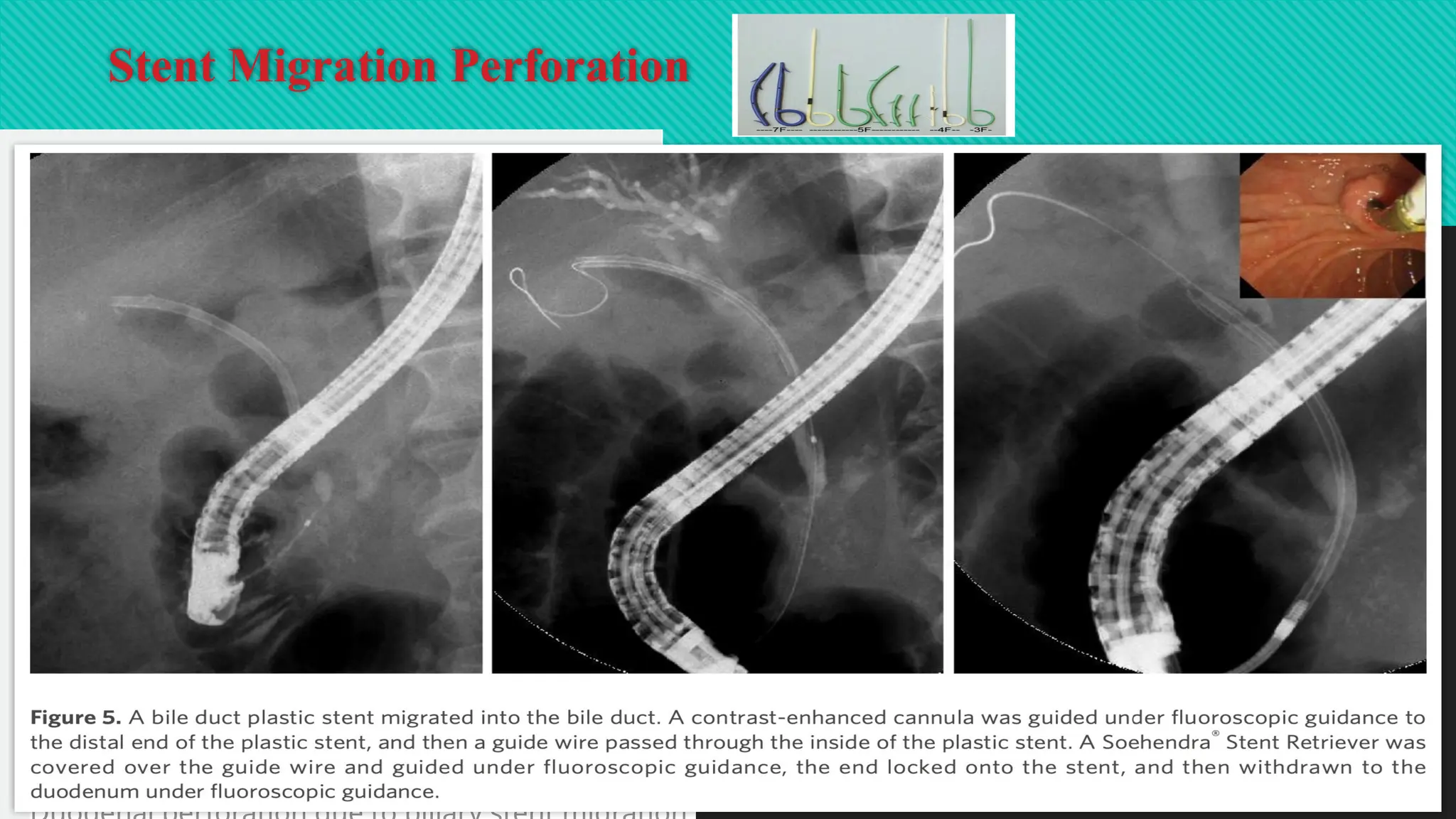 post ERCP pancreatitis.indications, cotraindications,types of ...