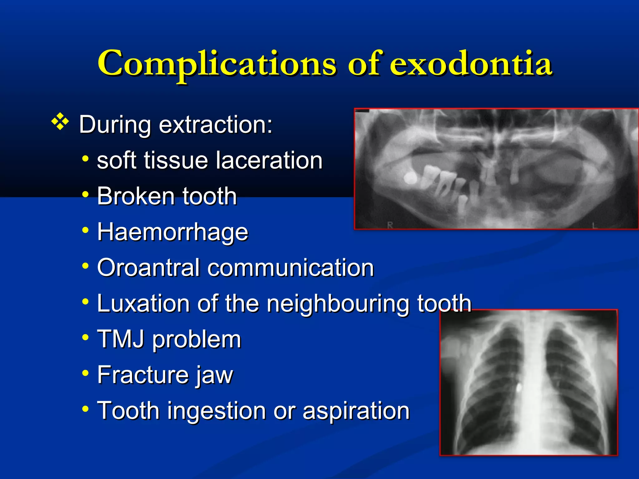 Complications of Exodontia | PPT
