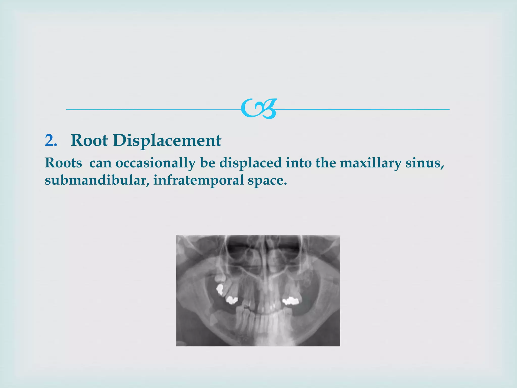 Complications of Extraction | PPTX