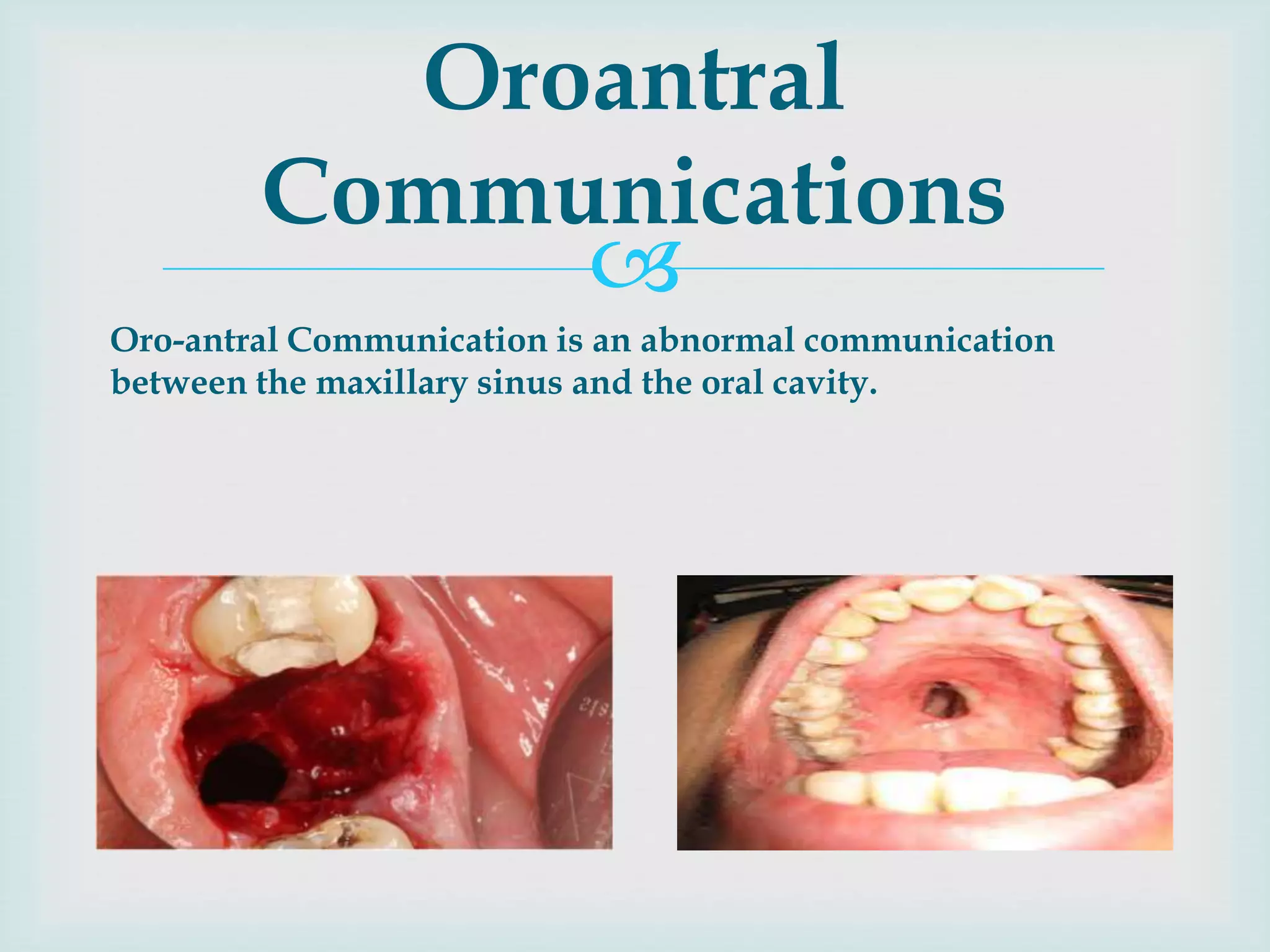 Complications of Extraction | PPTX
