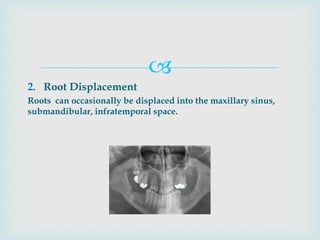 Complications of Extraction | PPTX