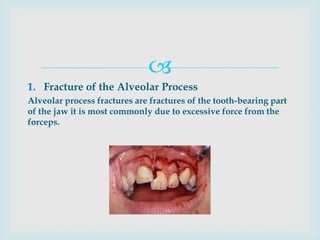 Complications of Extraction | PPTX