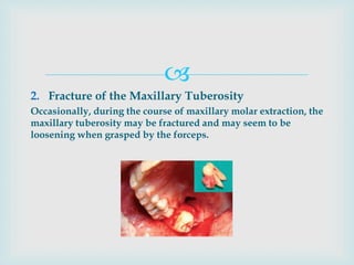 Complications of Extraction | PPTX